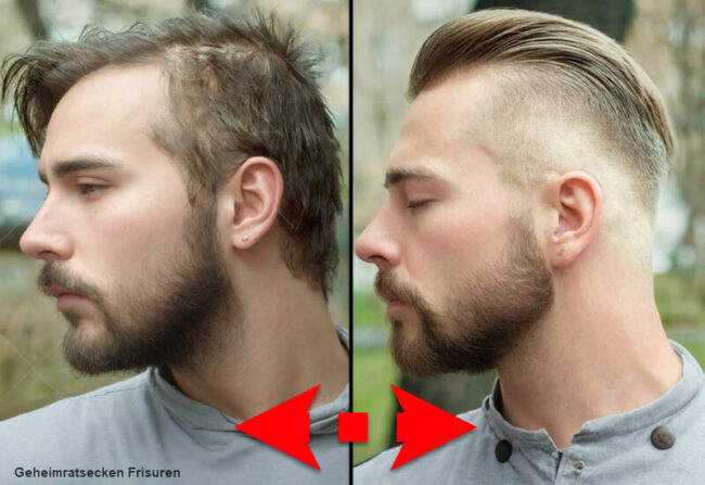 Geheimratsecken Frisuren (Tarnen Sie Kahlheit Geschickt!) – Frisuren